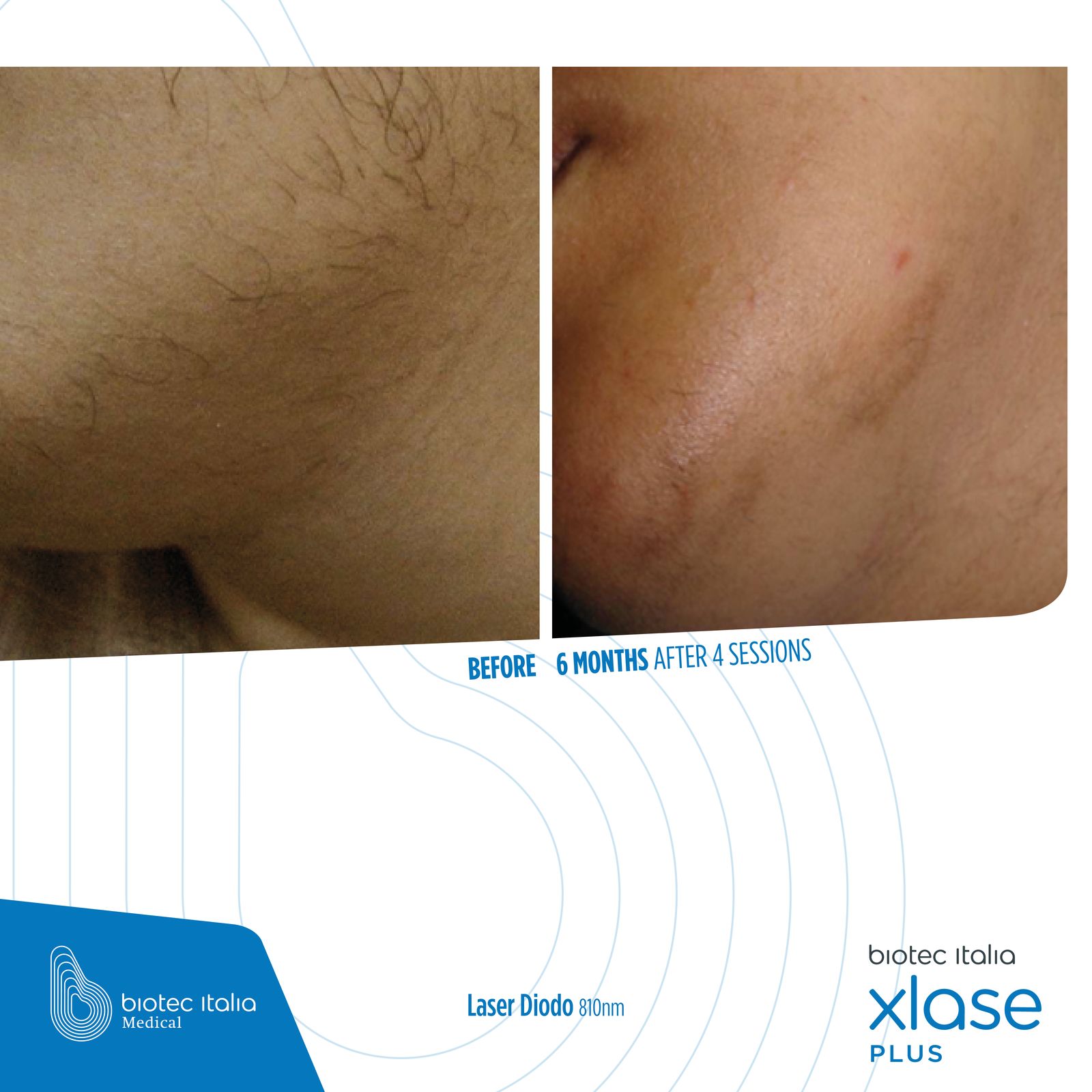 AlexPro 760/808/810 nm Diode Laser in Miami - Evoskin